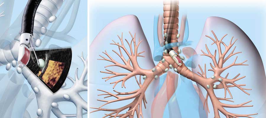 Endobronchial Ultrasound Training Course